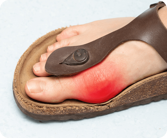 Hallux Limitus/Rigidus | DRJPRiar