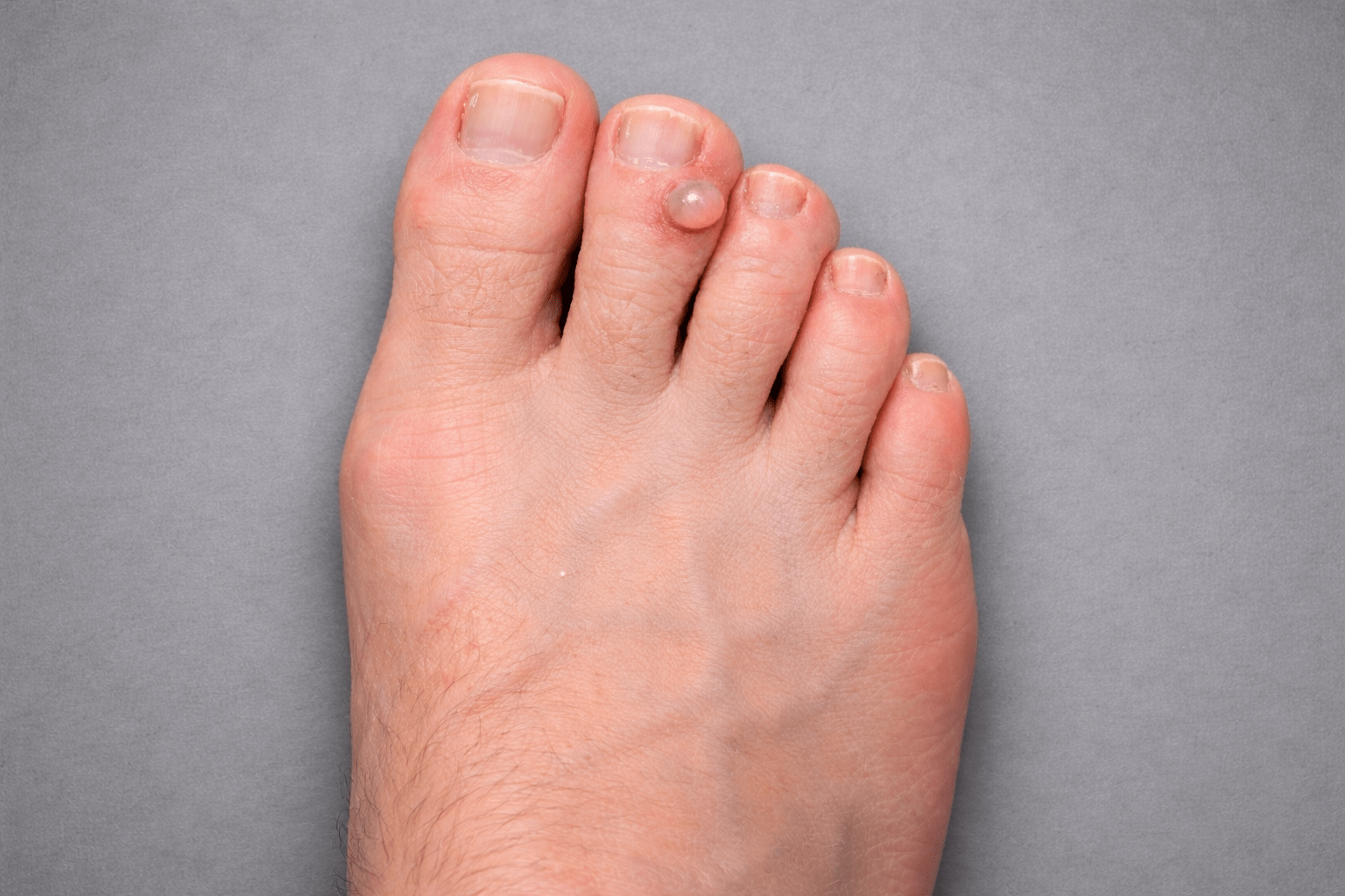 Mucoid Cyst | DRJPRiar