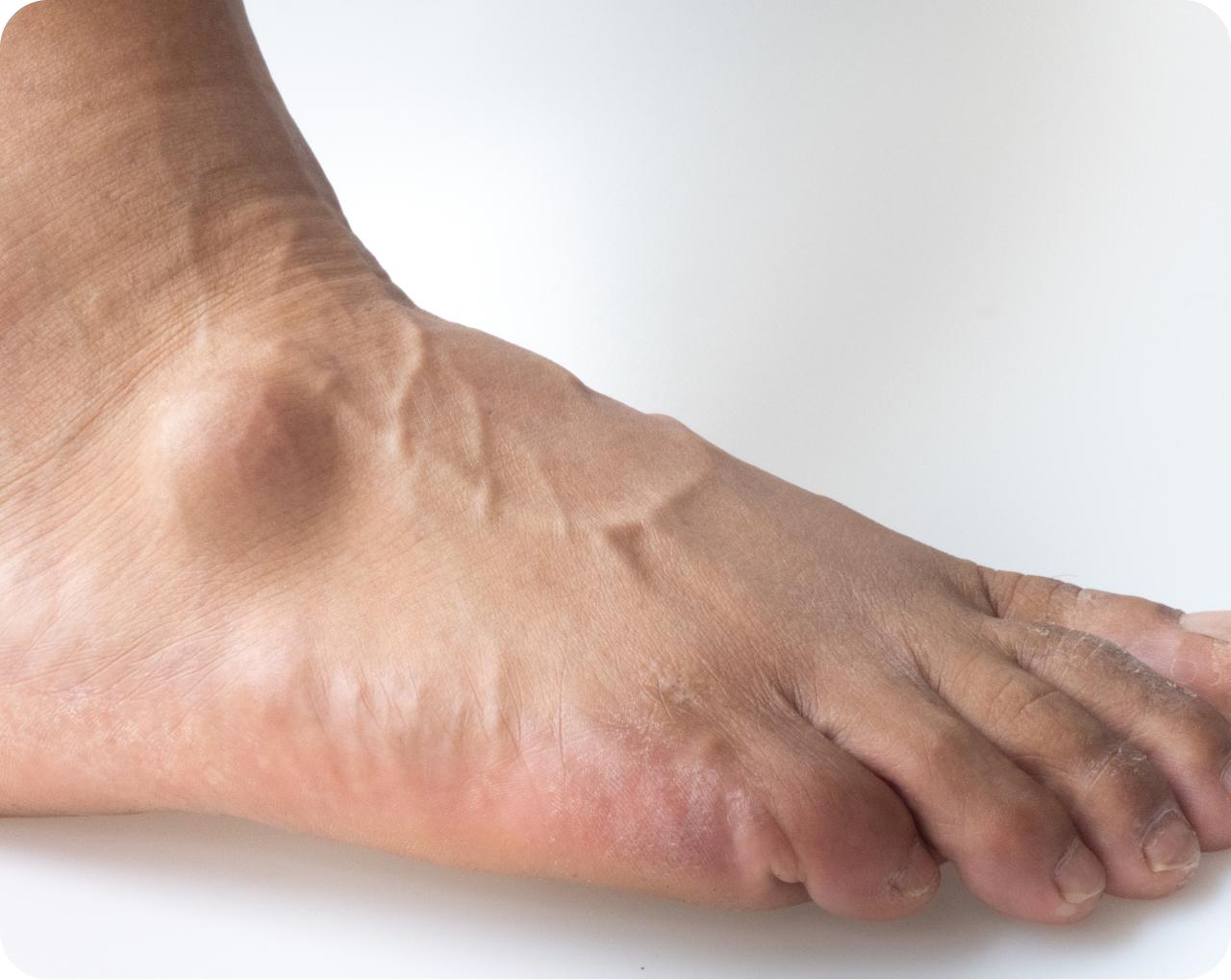 Mucoid Cyst | DRJPRiar