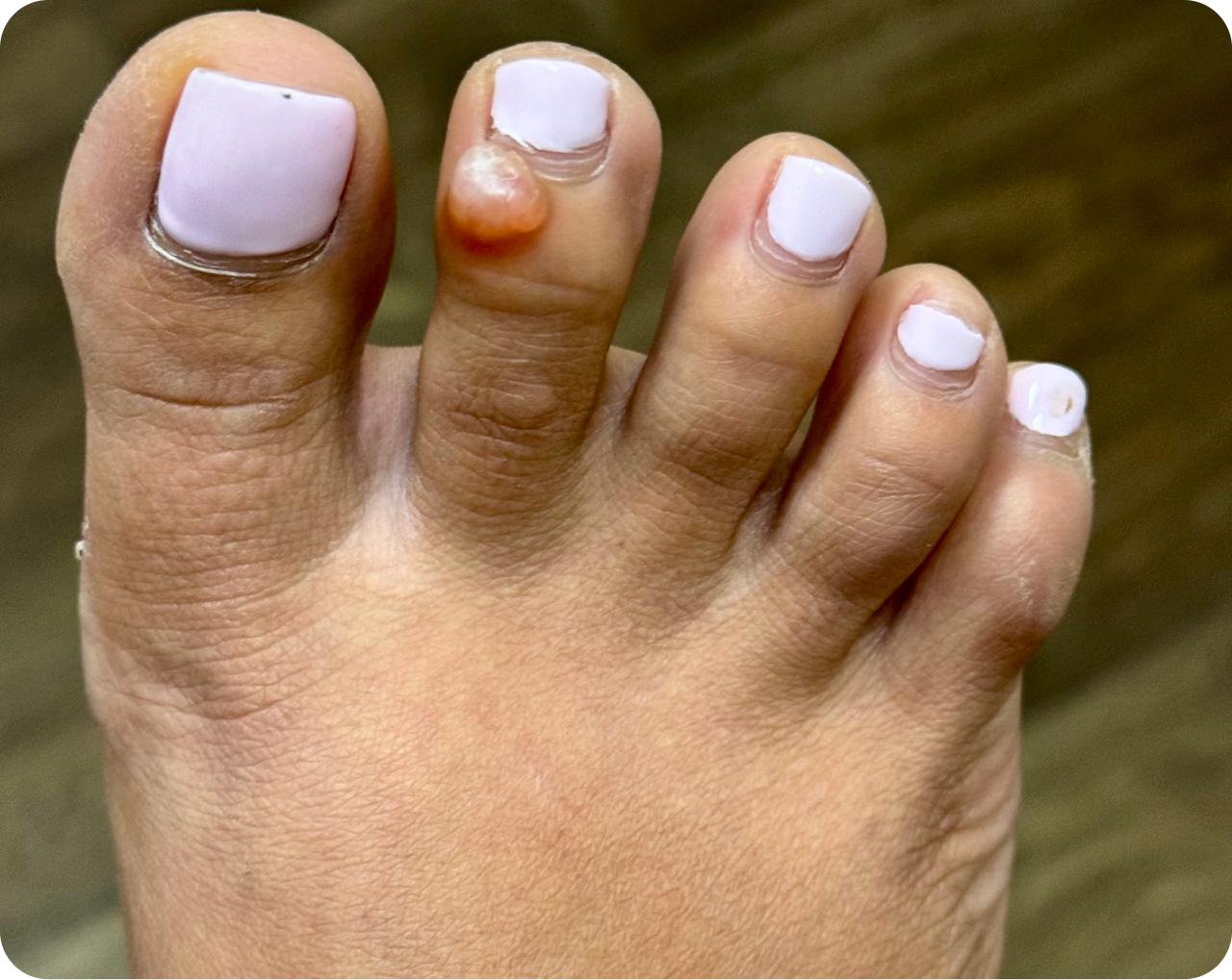 Mucoid Cyst | DRJPRiar